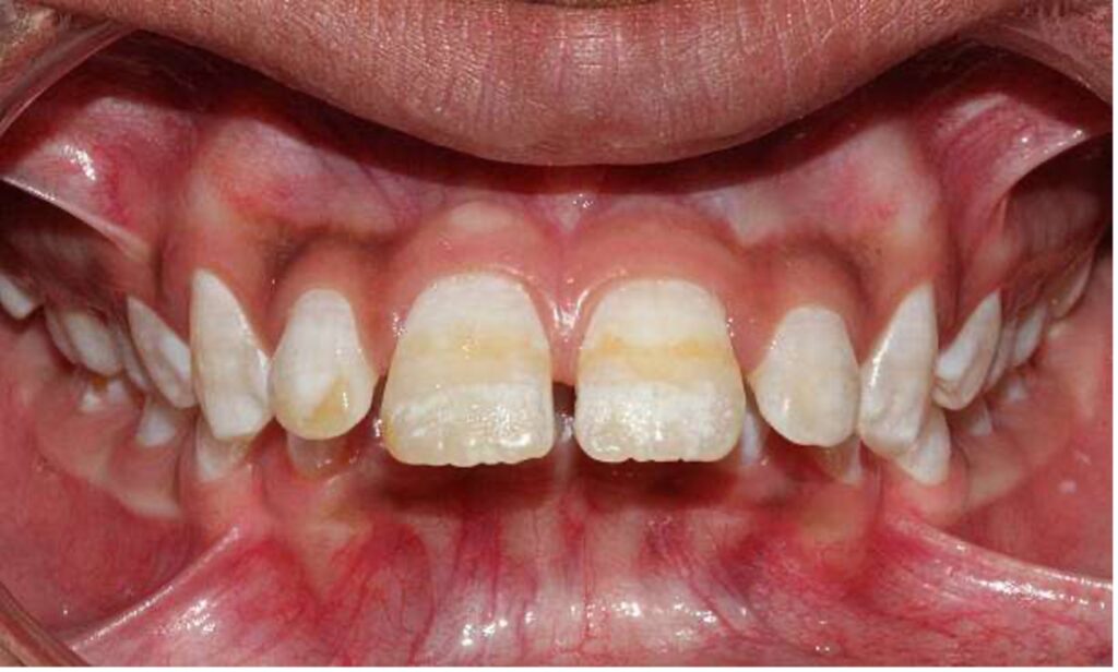 Fluoride In Kent | Crook Log Dental Practice | Kent